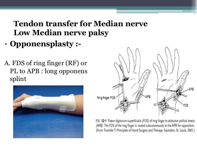 Pre and post operative management in tendon transfer