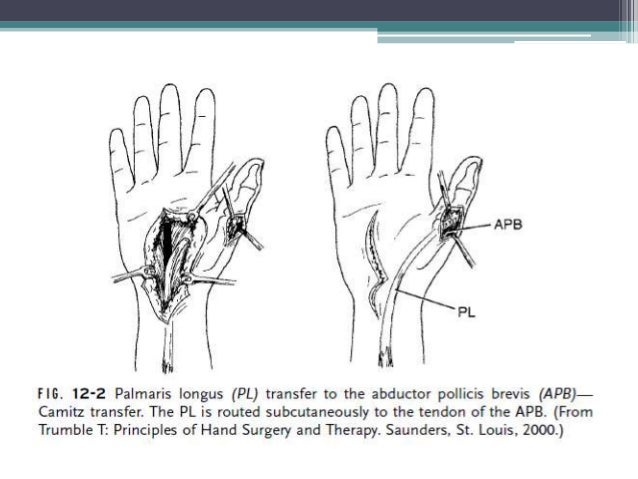Normal Anatomy In Which The Extensor Indicis Proprius Eip This