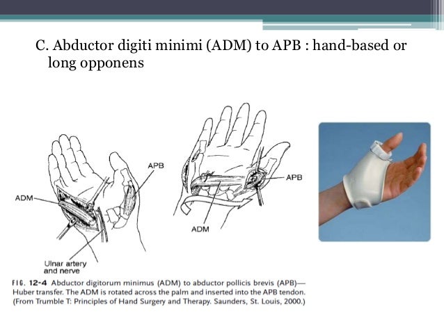 Pre and post operative management in tendon transfer