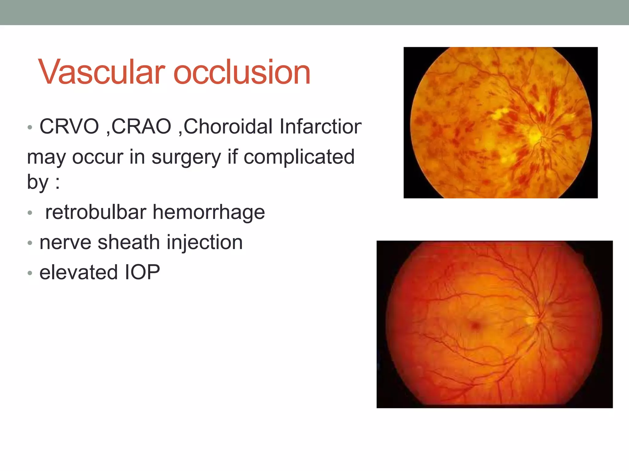 Pre and post operative management of cataract | PPTX
