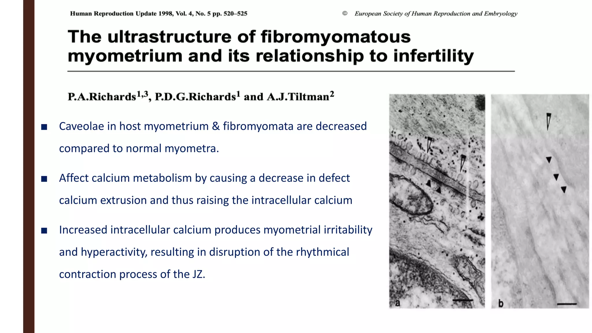 Pre-ART Management of Fibroids | PPTX