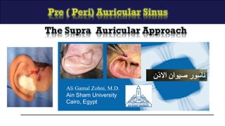 Preauricular Sinus Types ,presentstions and surgery | PDF