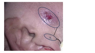 Preauricular Sinus Types ,presentstions and surgery | PDF