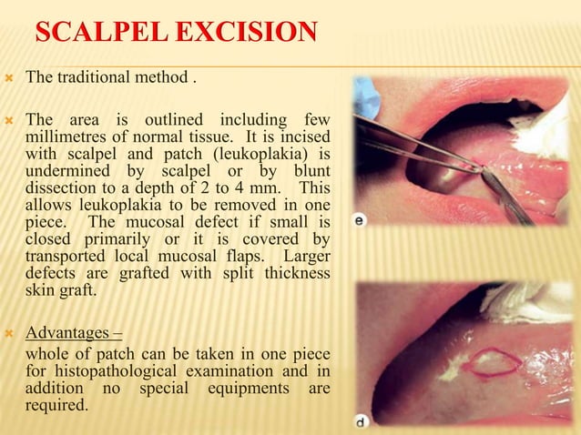 Pre cancerous lesions & conditions | PPTX