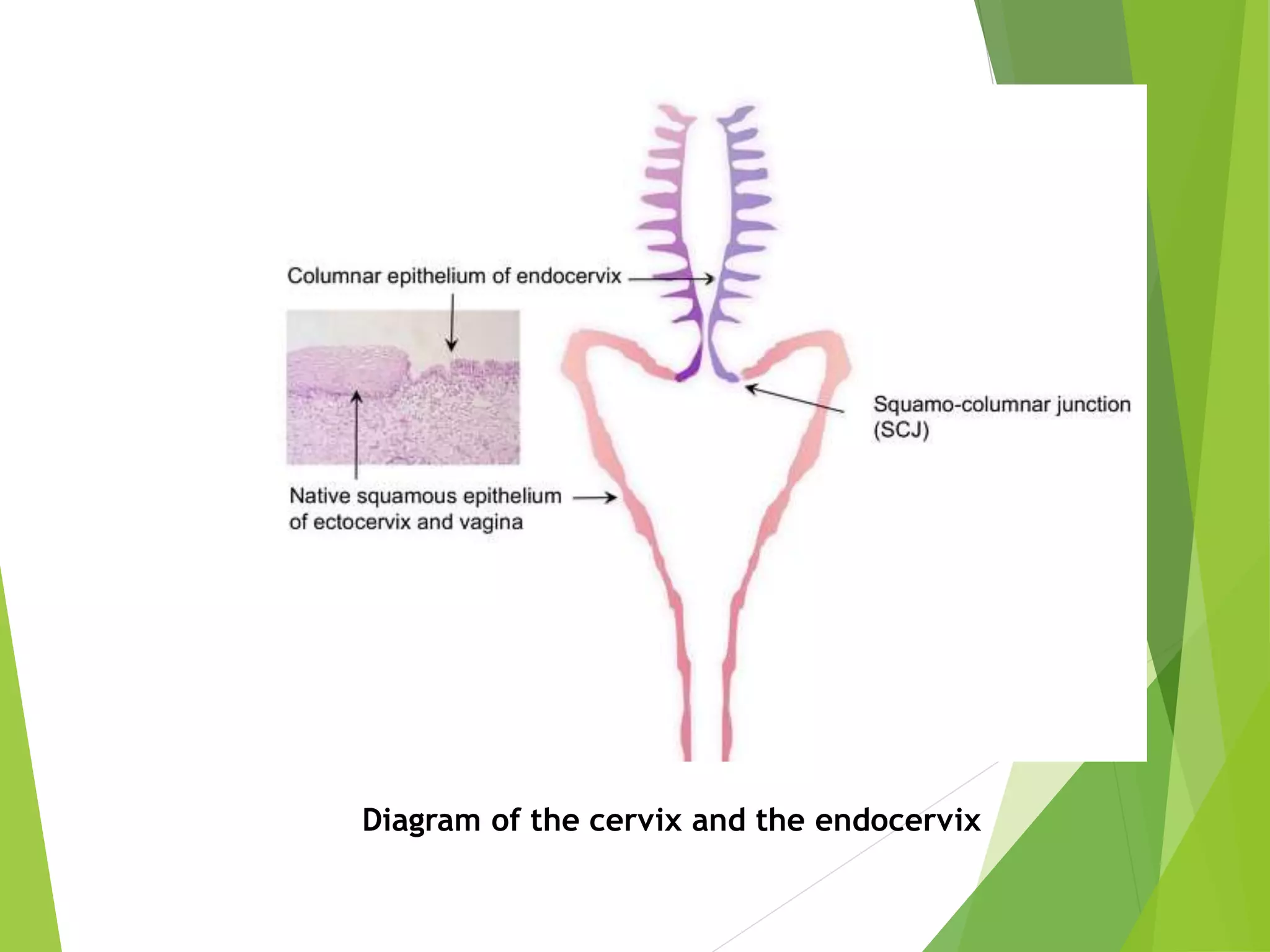 Pre cancerous lesions of cervix.pptx