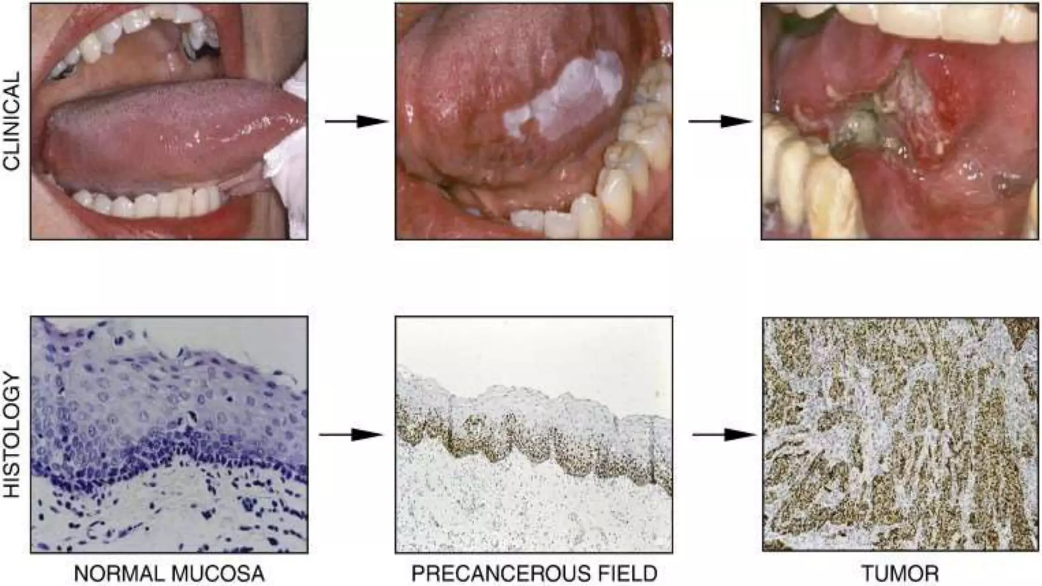 Precancerous lesions of oral cavity | PPTX