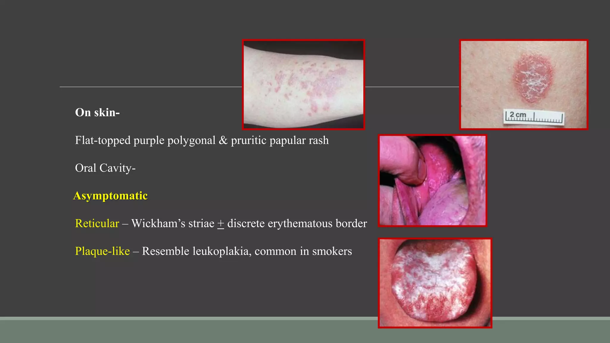 Precancerous Lesions Of Oral Cavity Pptx