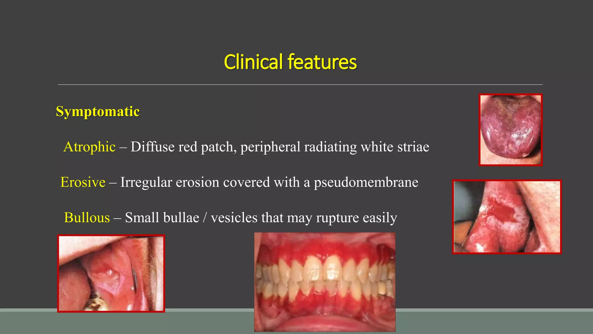 Precancerous lesions of oral cavity | PPTX