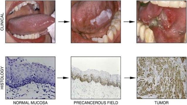 Precancerous lesions of oral cavity | PPTX | Skin and Dermatology ...