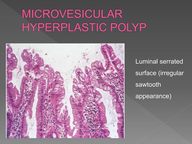 Pre cancerous colonic polyp | PPT | Free Download