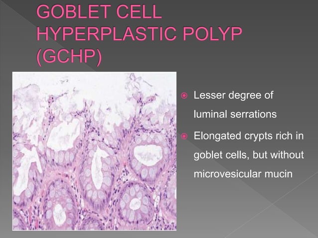 Pre cancerous colonic polyp | PPT | Free Download
