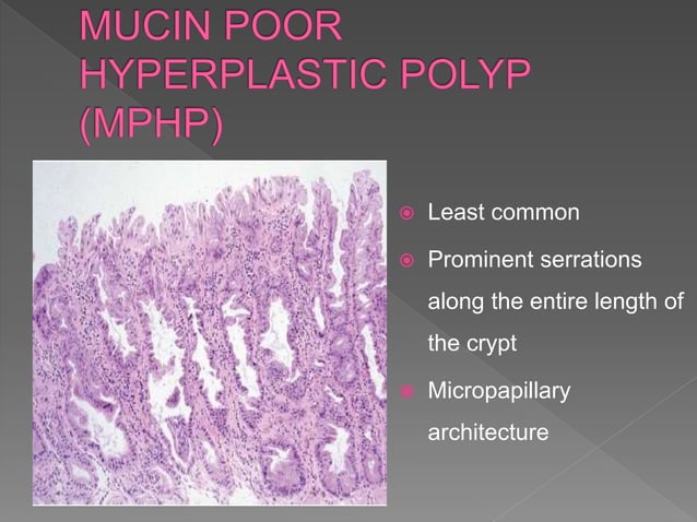 Pre cancerous colonic polyp | PPT