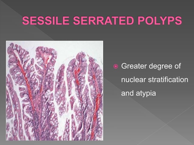 Pre cancerous colonic polyp | PPT | Free Download