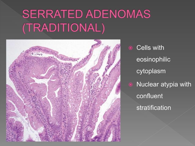 Pre cancerous colonic polyp | PPT