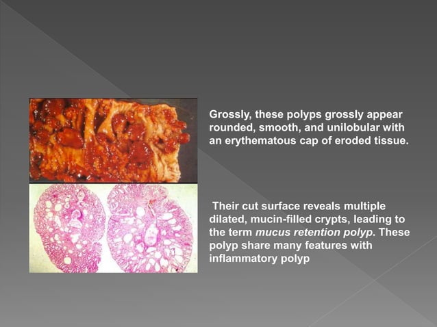 Pre cancerous colonic polyp | PPT
