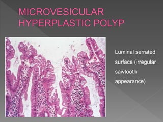 Hyperplastic Polyp Sawtooth