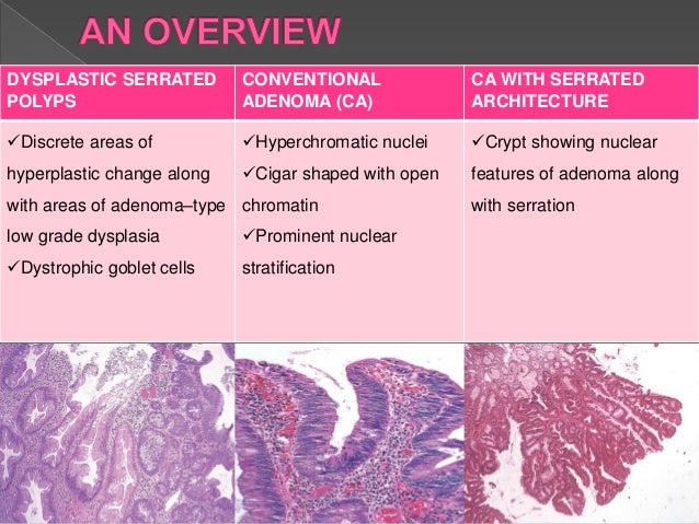 Pre cancerous colonic polyp