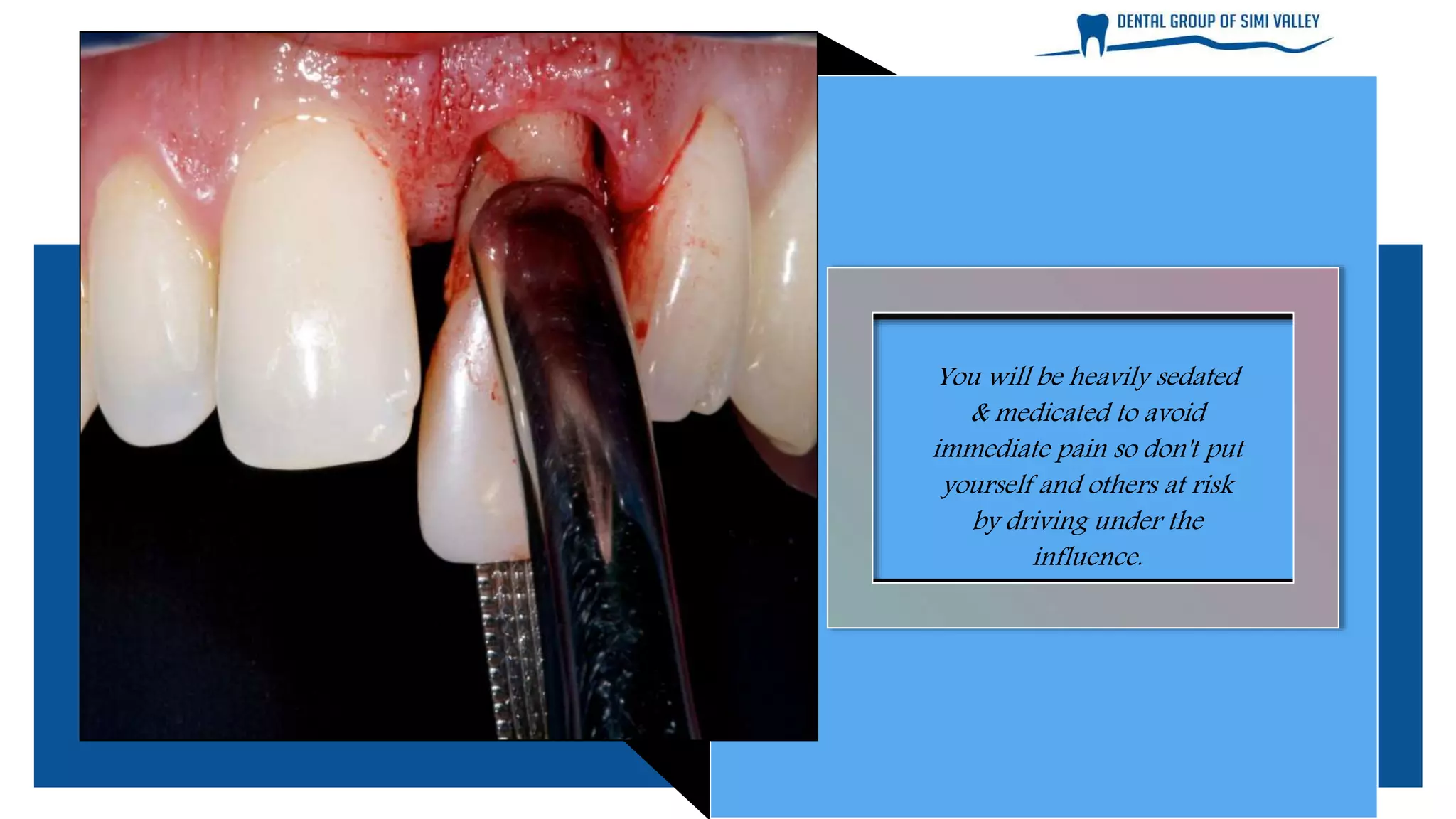 Precautions to Follow after having a Tooth Extraction | PPT