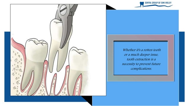 Precautions to Follow after having a Tooth Extraction | PPT
