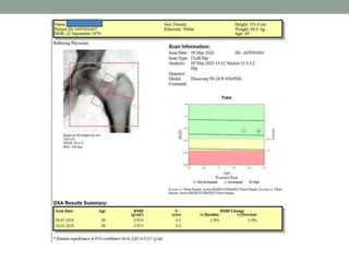 Precision and follow up scans in bone densitometry | PPTX