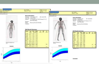 Precision and follow up scans in bone densitometry | PPTX