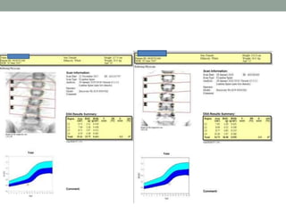 Precision and follow up scans in bone densitometry | PPTX