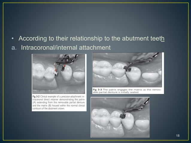 Precision attachment | PPTX | Jewelry Making | Arts and Crafts