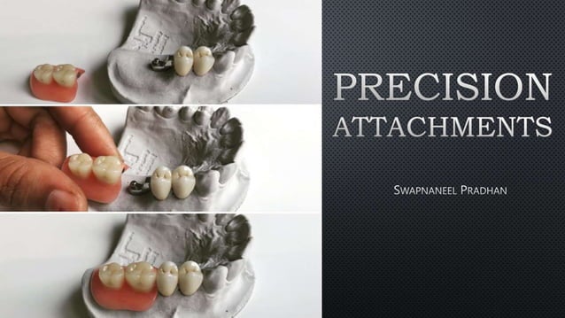 Precision attachment.pptx | Dental Health | Diseases and Conditions
