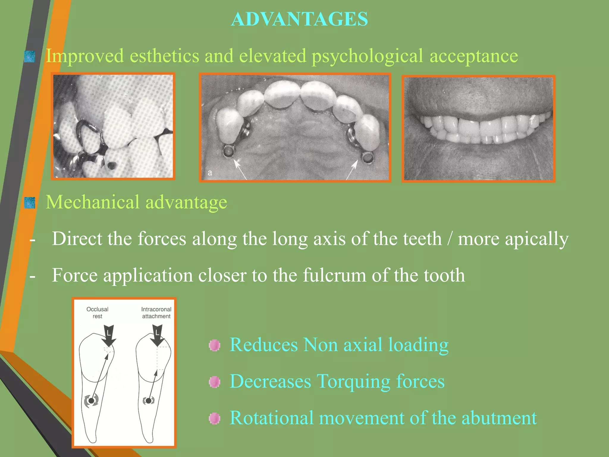 Precision attachments | PDF