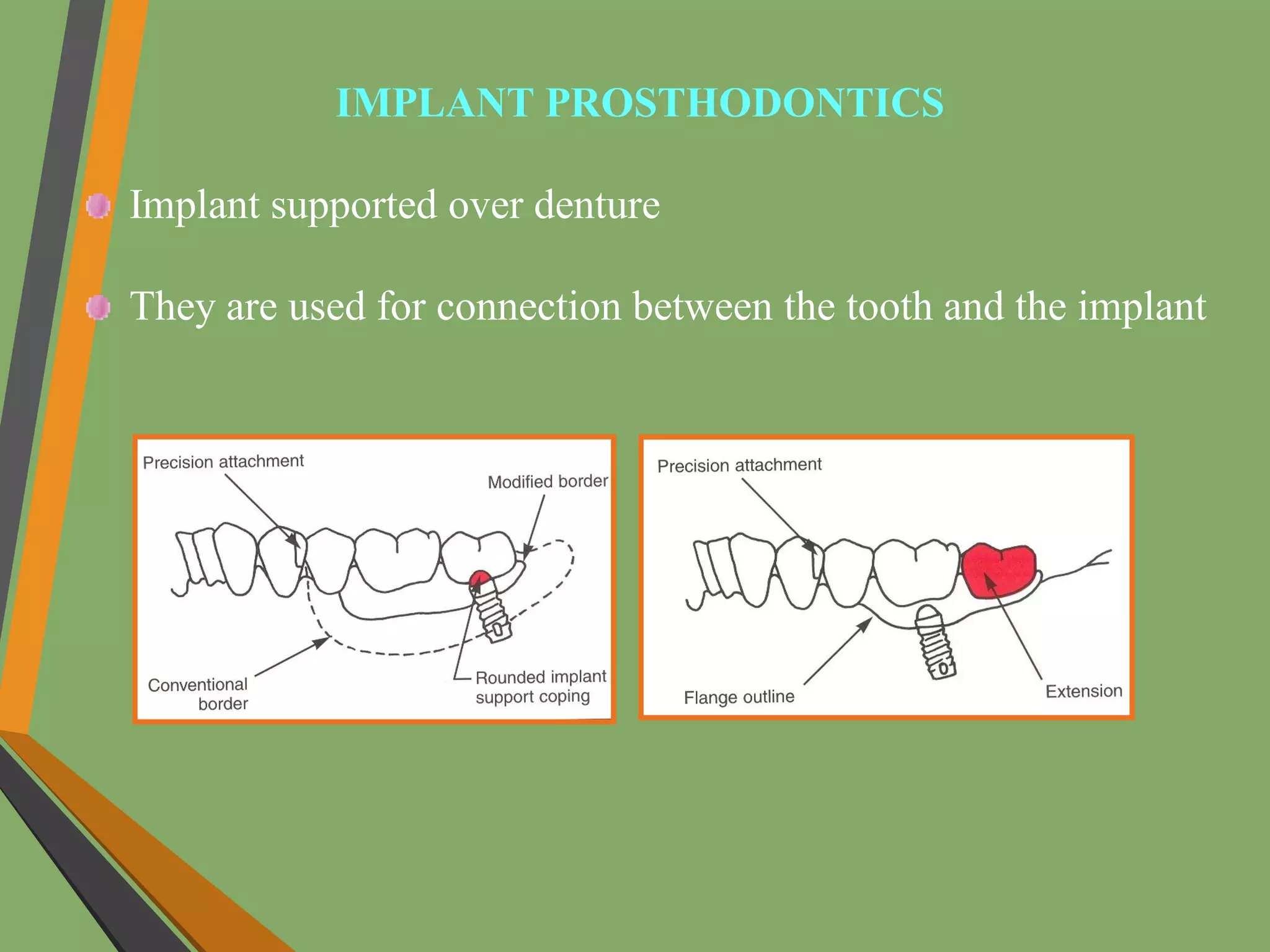 Precision attachments | PDF