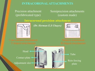 Precision attachments | PPT