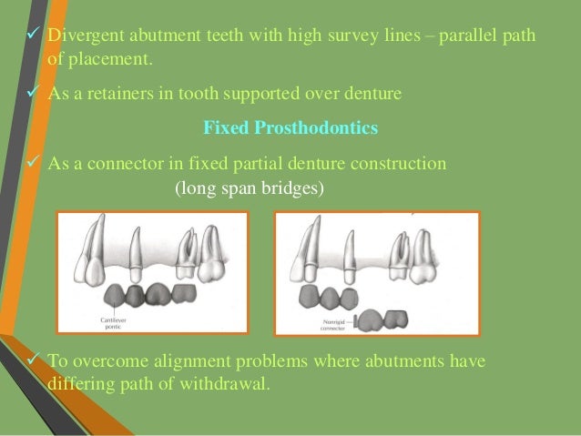 Precision attachments