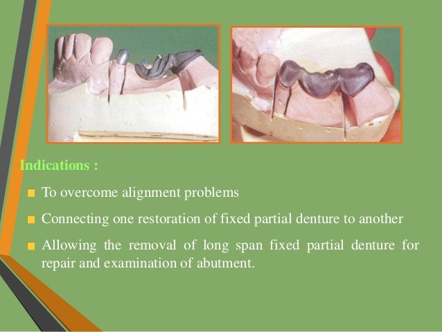 Precision attachments