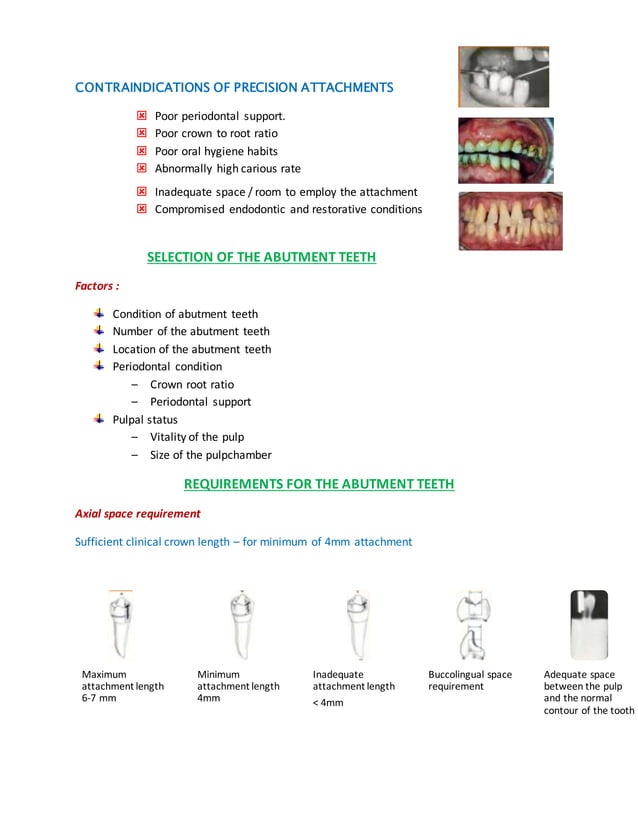 Precision attachments | DOCX | Dental Health | Diseases and Conditions