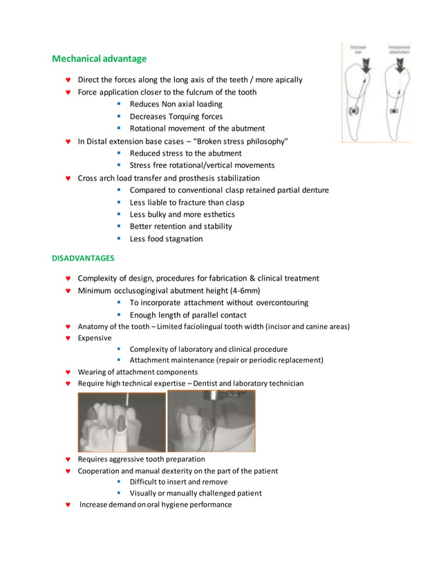 Precision attachments | DOCX | Dental Health | Diseases and Conditions