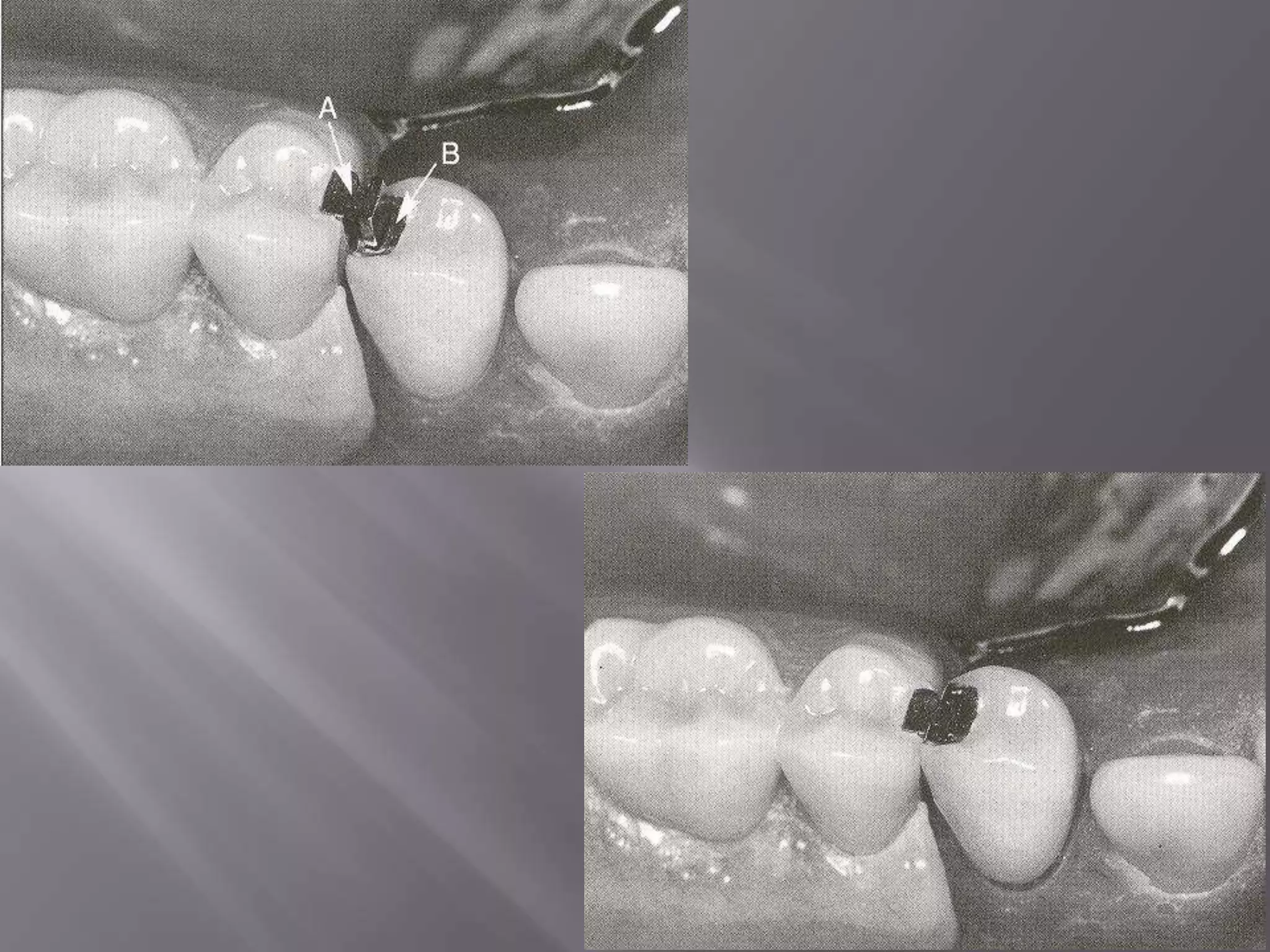 Precision attachments | PPTX