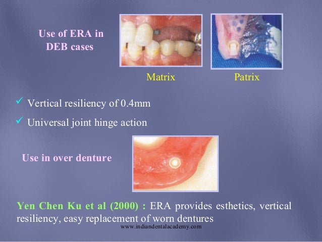 Precision attachments final/ dental implant courses