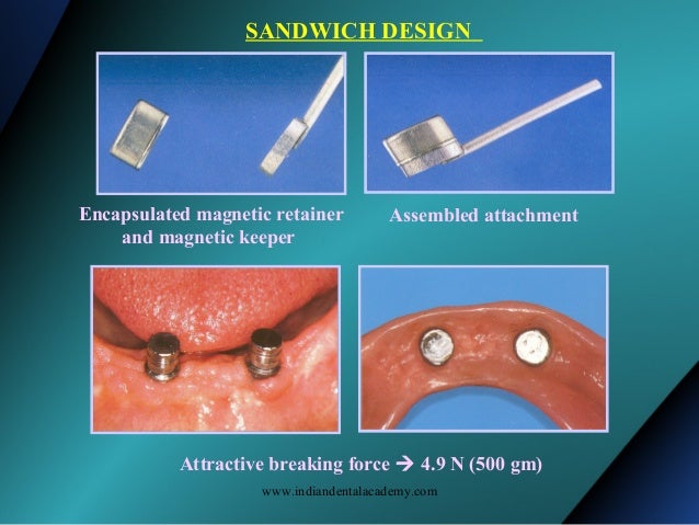 Precision attachments final/ dental implant courses