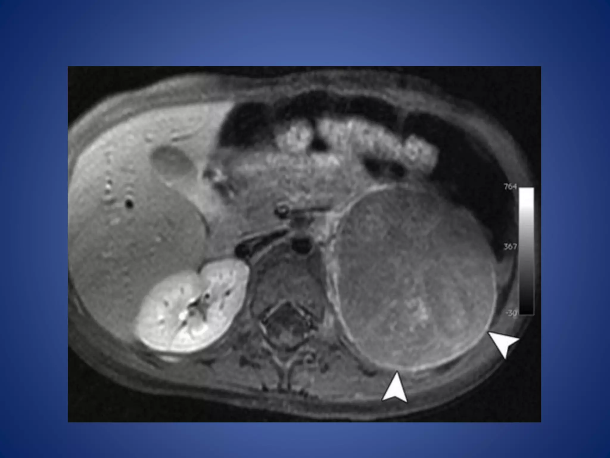 Precocious puberty | PPT