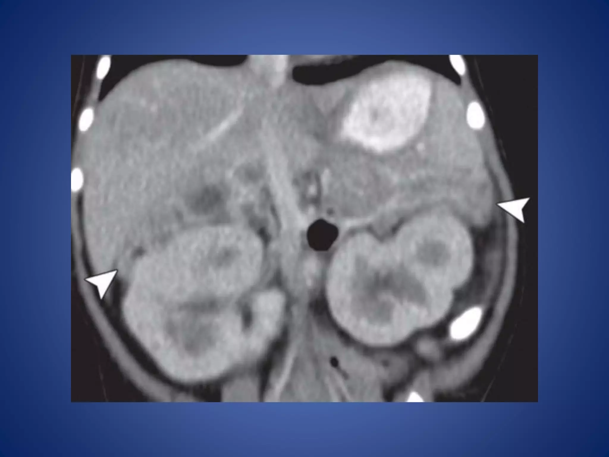 Precocious puberty | PPT