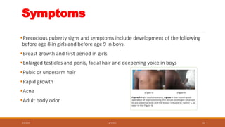 Precocious puberty | PPTX