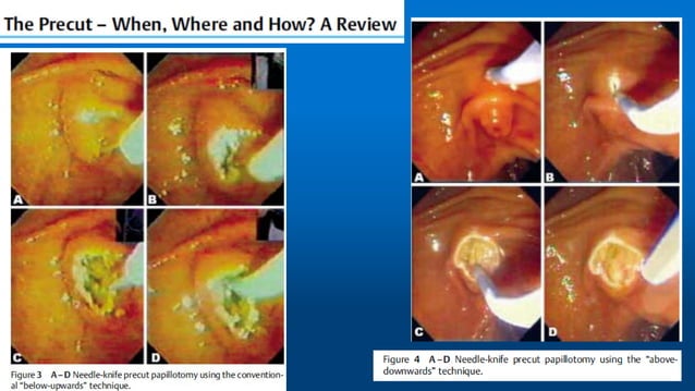 Precut ERCP, Fistulotomy, Papillotomy, Transpancreatic sphincterotomy ...