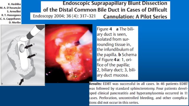 Precut ERCP, Fistulotomy, Papillotomy, Transpancreatic sphincterotomy ...