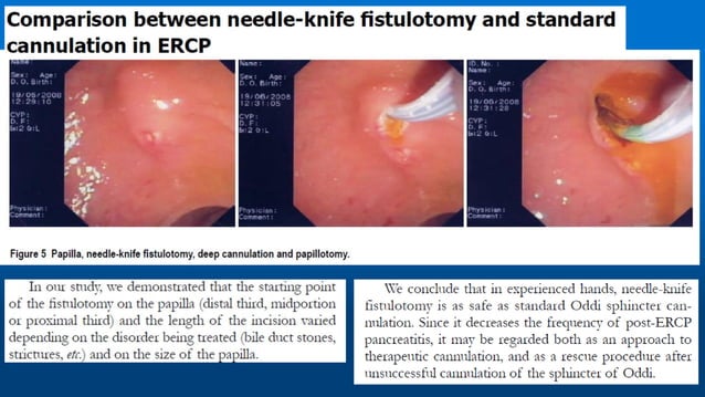 Precut ERCP, Fistulotomy, Papillotomy, Transpancreatic sphincterotomy ...