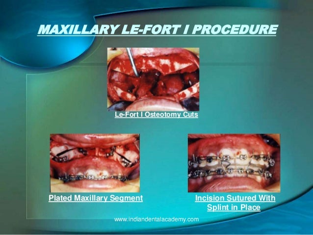 Prediction of maxillary repositioning in lefort 1 surgery /certified
