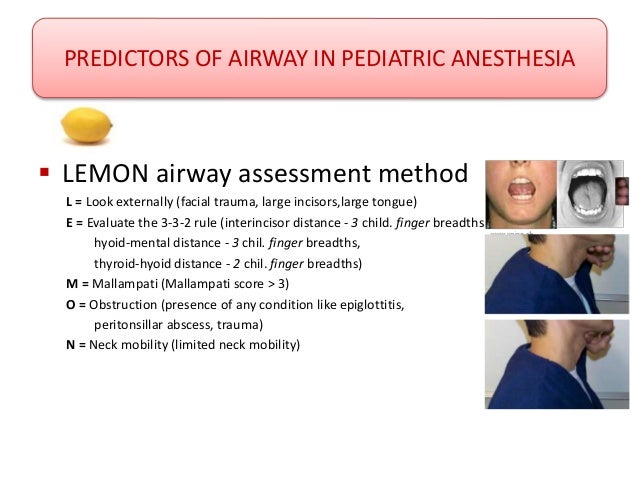 Predictors of airway in pediatric anesthesia podgorica 2014