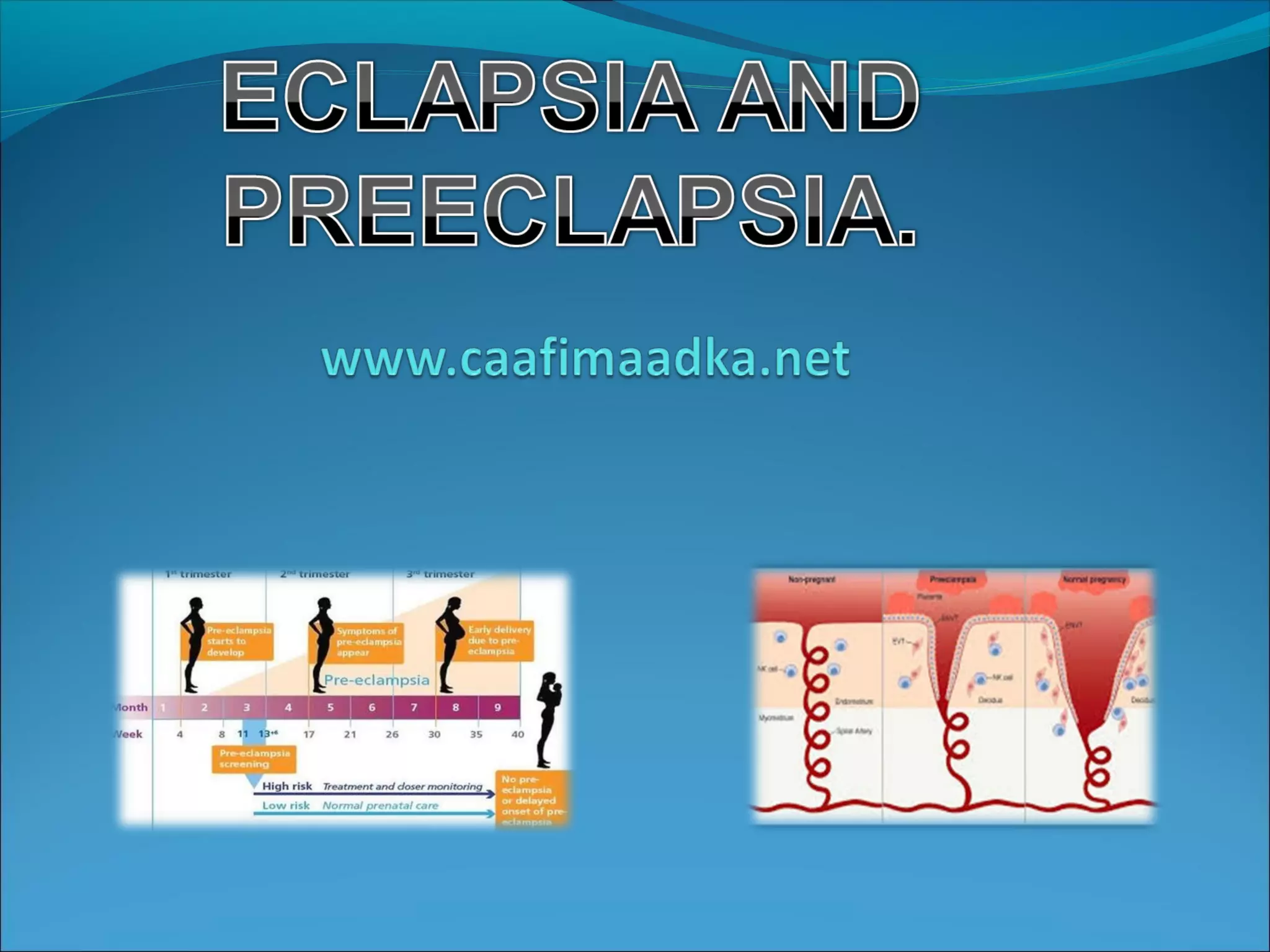 Preeclampsia and eclampsia | PPT