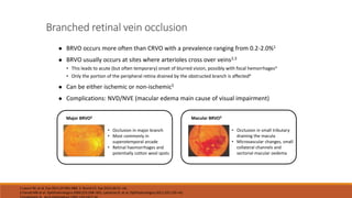 Prefered treatment for the management of BRVO -AJAY DUDANI | PPTX