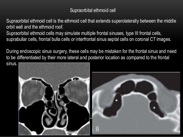 Ethmoid Roof Anatomy Figure 6 Cbct Coronal View Ethmoid Bone