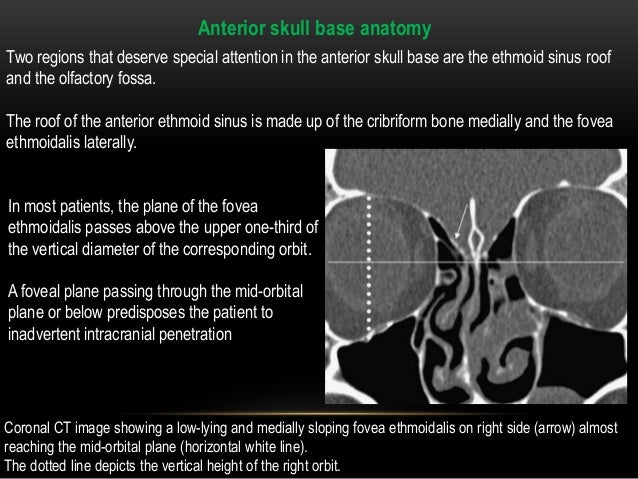 Pns Ct Anatomy